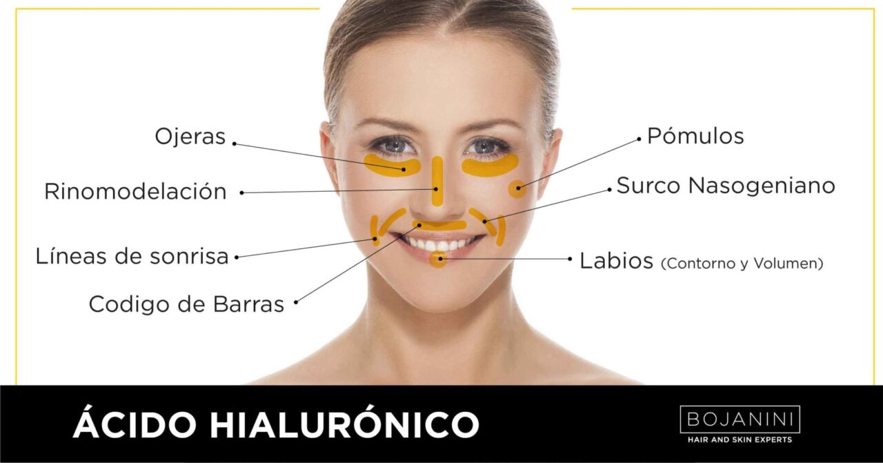 Ácido Hialurónico Inyectado ¿Para qué? - Bojanini Colombia