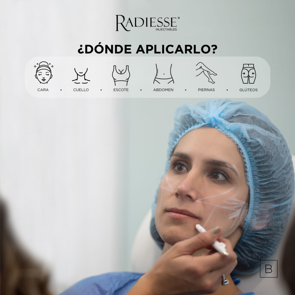 Radiesse: El Bioestimulador de colágeno que mejorará tu piel